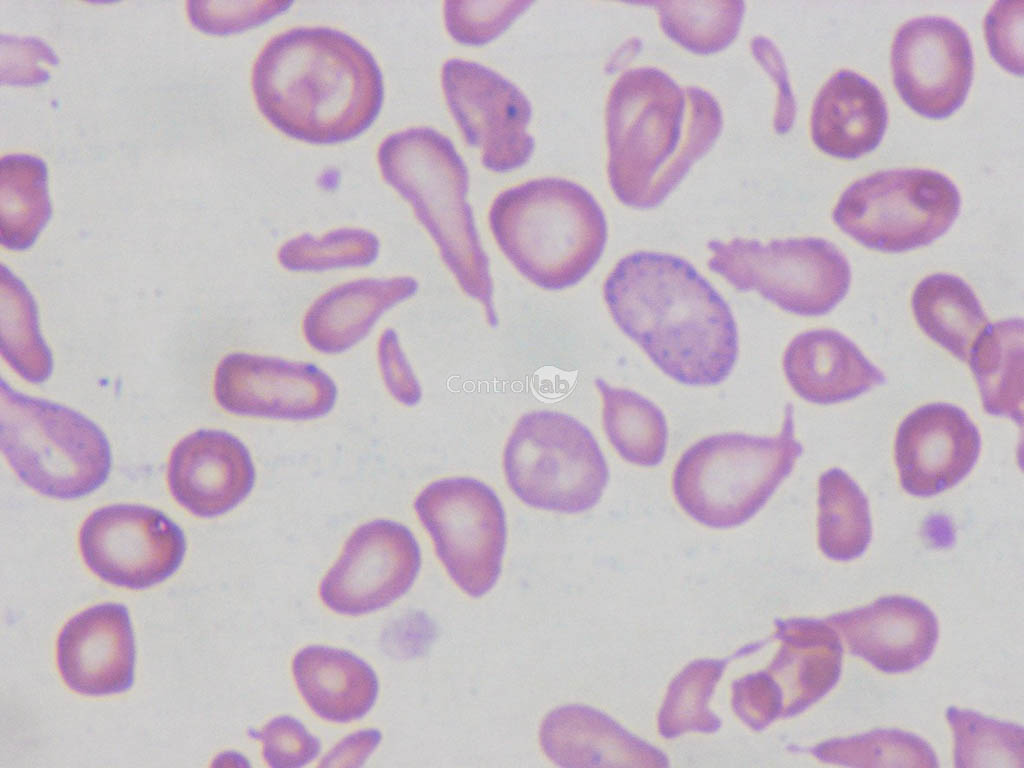 Hematologia | Hemograma - Série Vermelha – Controllab